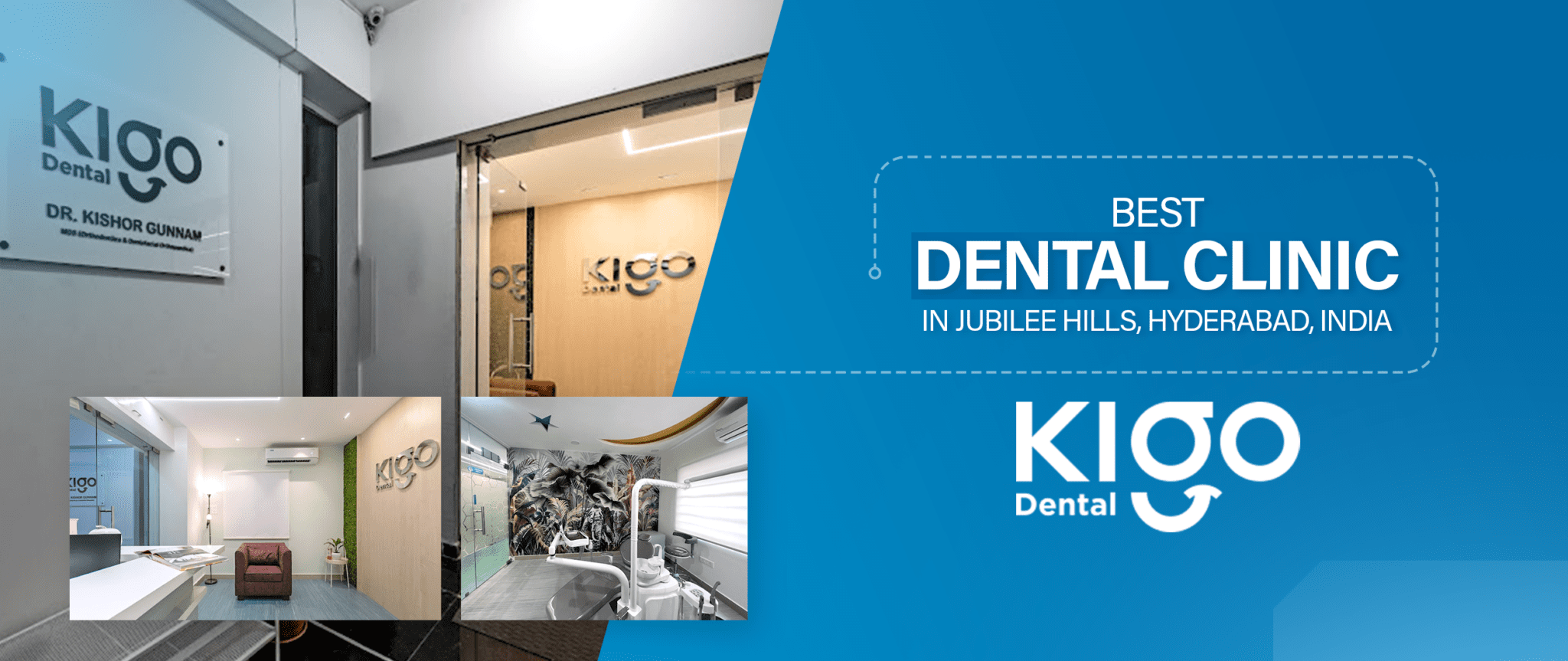 Dental Veneers Laminates in Hyderabad - KigoDental